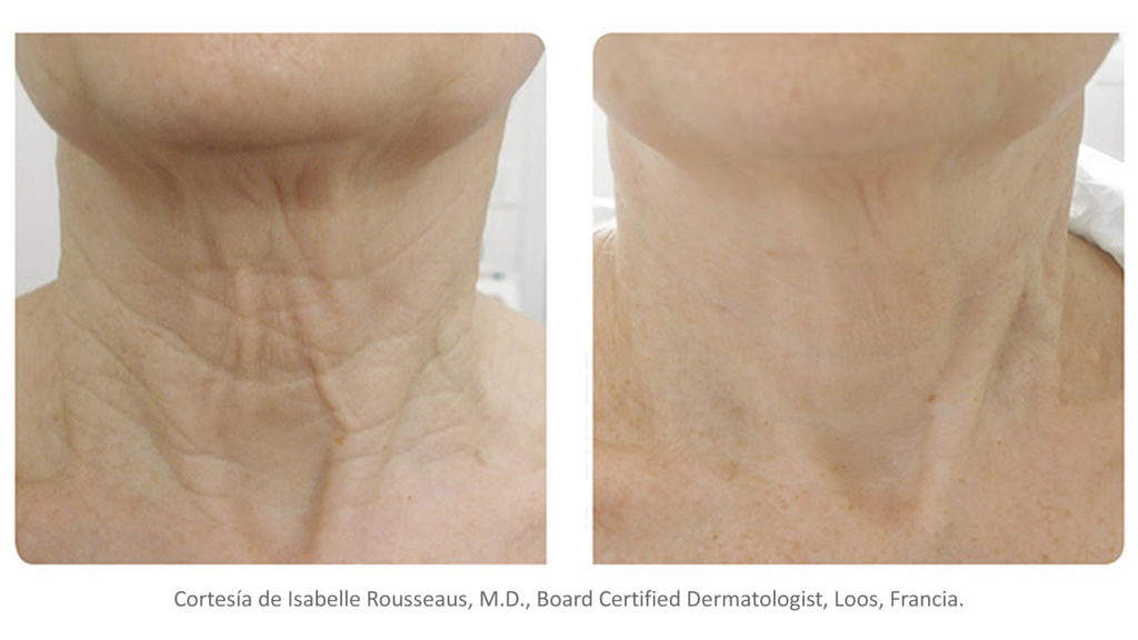 Radiofrecuencia facial en Granada - Quintalegre Médico Estética