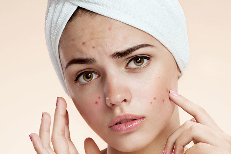 Acné e imperfecciones - Quintalegre CME